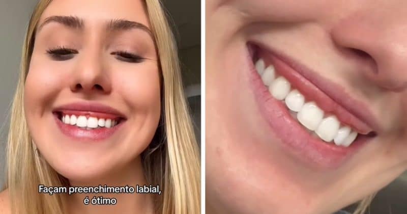 Influenciadora “ganha terceiro lábio” após preenchimento na boca dar ...